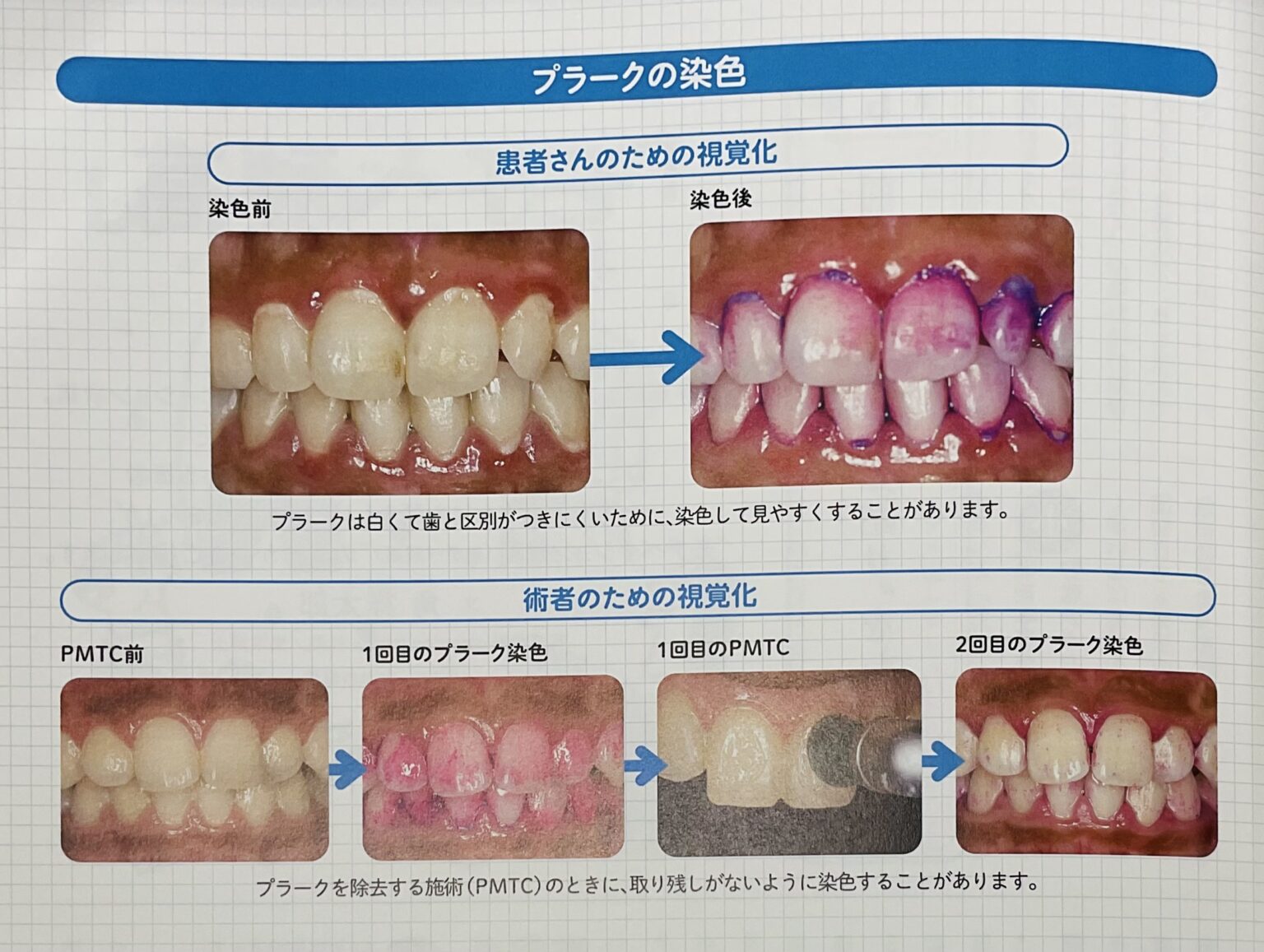 歯周病、虫歯の予防にPMTC ｜北浦和の歯医者｜北浦和かねこ歯科クリニック